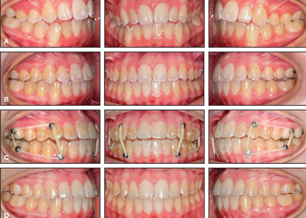 Adjuncts In Clear Aligners Pristine Clear Aligners